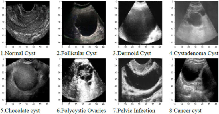 Chist ovarian: Simptome, complicații, tratament - Medisprof